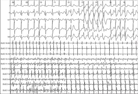 Flutter Auricular 1 1 Tras La Administración De Vernakalant Para