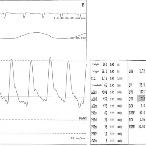 A Right Cardiac Catheterization In A Cteph Patient Not A Candidate Download Scientific