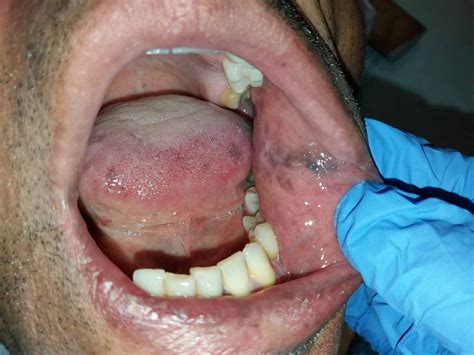 Addison Disease Oral