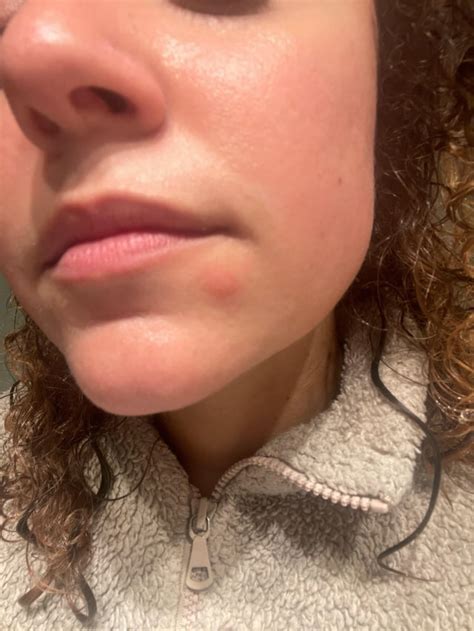 Red Bump On Face Has Been There A Few Hours Now Itchy Only When I