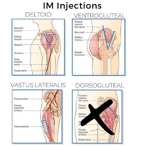 Ventrogluteal Injection Landmarks