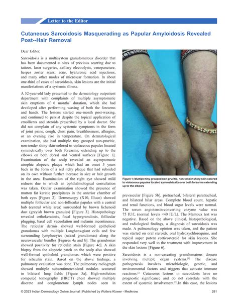 Pdf Cutaneous Sarcoidosis Masquerading As Papular Amyloidosis