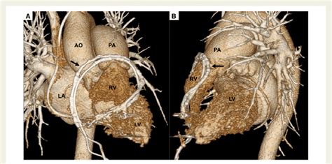 Three Dimensional Computed Tomography Before Removal Of The Epicardial