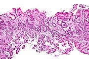 Gastric Antral Vascular Ectasia Libre Pathology