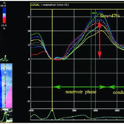The Normal Graph Of La Longitudinal Strain By P Wave Triggering Method Download Scientific