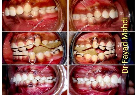 12 Years Old Female With Class 2 Div 1malocclusion On Skeletal Base 2