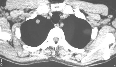 肺结核 常见病x线诊断