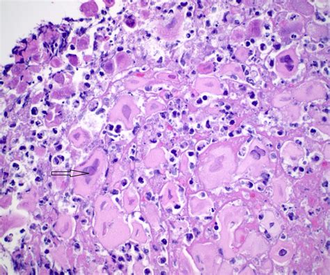 Pathology Outlines Eosinophilic Esophagitis