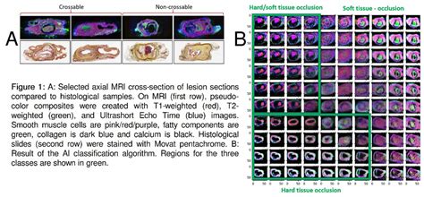 Semiautomated Classification Of Peripheral Artery Disease Lesion Composition From Multicontrast