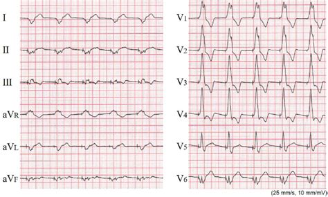 Figure2 The Post Implantation Electrocardiography At Rest Under Pacing Download Scientific