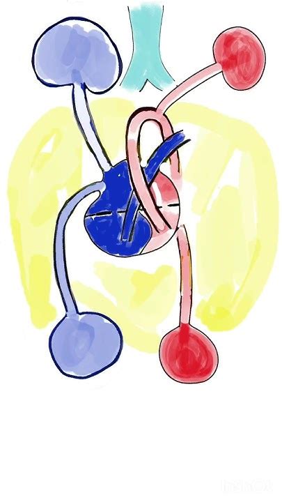 Pulsus Paradoxus In Cardiac Tamponade Cardiology Usmle Neet Mbbs Usmlepreparation Neet2024