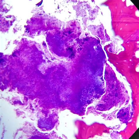 Shahriar Shafaei On Linkedin Jaw Bone Actinomyces Osteomyelitis