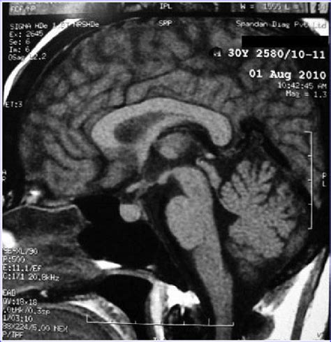 T1 Weighted Image Of Pituitary Showing Pituitary Hyperplasia