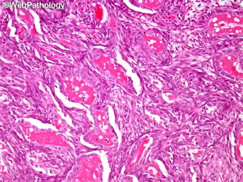 Synovial Sarcoma