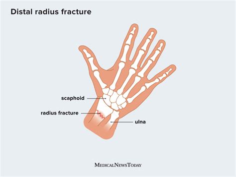 Wrist Fracture Risk Factors Treatment And Recovery