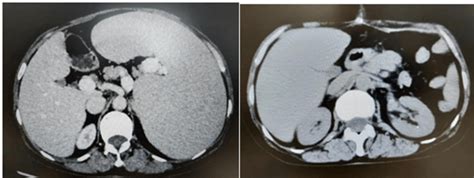 Splenectomy Before Allogeneic Hematopoietic Stem Cell Transplantation For Myelofibrosis Two
