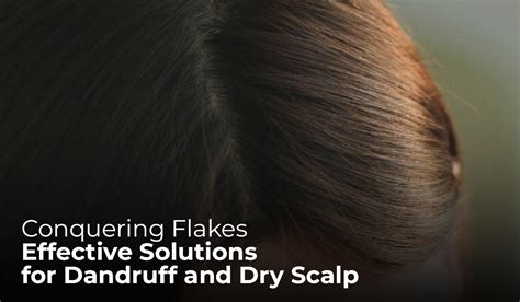 Conquering Flakes Effective Solutions For Dandruff And Dry Scalp Nouveau Beauty House