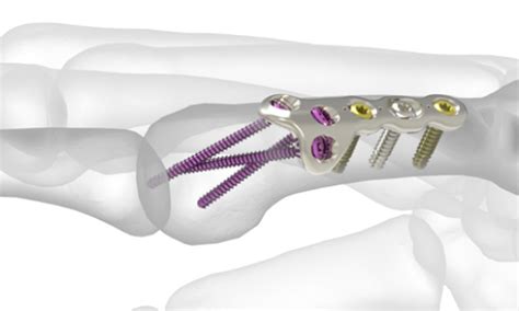 Hand Fracture System Acumed