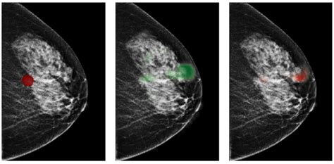 An Example Of Saliency Maps From Left To Right A Mammogram Image Of A