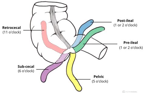 Acute Appendicitis Flashcards Quizlet