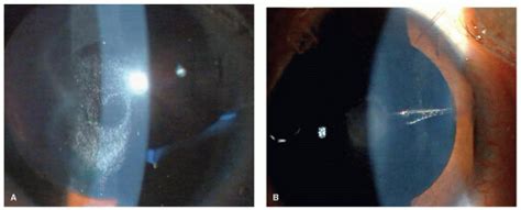 Intraocular Triamcinolone In Pediatric Cataract Surgery Ento Key