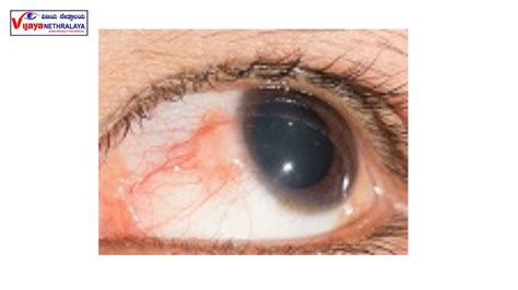 Episcleritis Understanding The Symptoms Causes Treatment