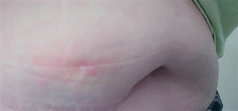 1st Sublocade Injection R Sublocade