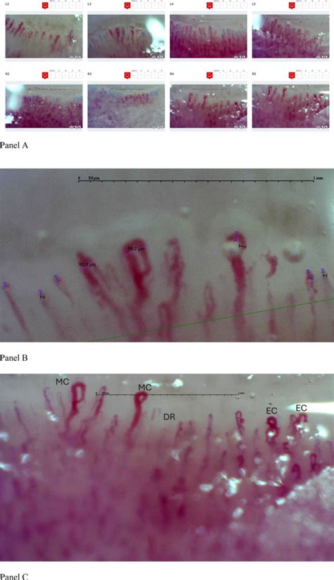 Multifactorial Induction Of A “scleroderma‐like Pattern” Without