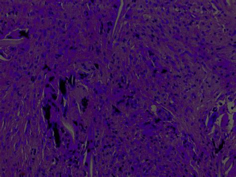 Multinuclear Giant Cells Around Foreign Body Magnification Â200 Download Scientific Diagram