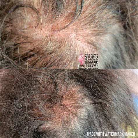 Scalp And Beard Micropigmentation Face Naked Studio
