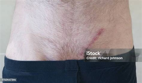 Foto De Cicatriz De Hérnia Pósoperatória No Homem E Mais Fotos De Stock