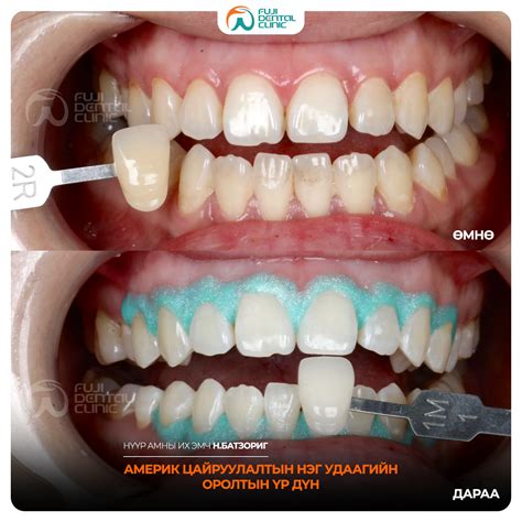 Fuji 🦷Америк цайруулалтын нэг удаагийн оролтын үр дүн 👨‍⚕️Нүүр амны их эмч Н Батзориг 🌟Та Fuji