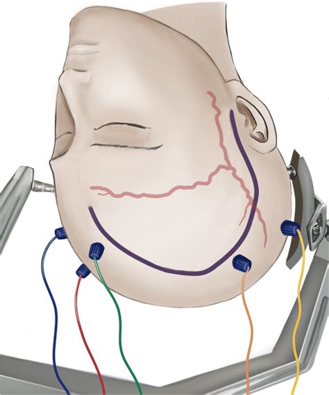 Artist Drawing Shows Scalp Incision Download Scientific Diagram