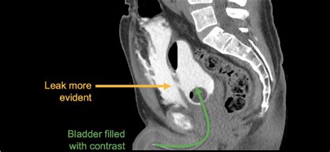 Abdominal Ct Bladder Injuries • Litfl • Radiology
