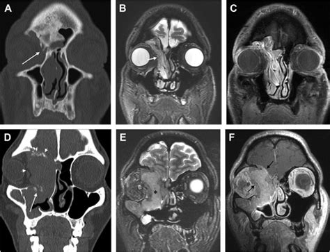 Malignant And Nonmalignant Sinonasal Tumors Oral And Maxillofacial