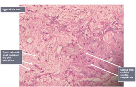 Hypocellular Areas Contain Abundant Myxoid Matrix Punctuated By