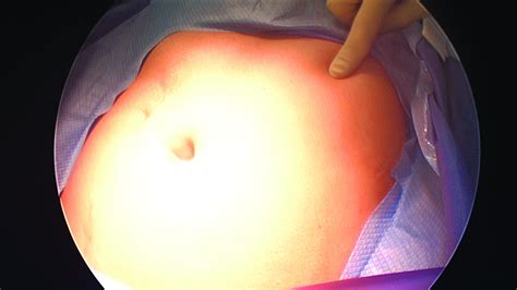 Left Upper Quadrant Entry Is Often A Reliable Alternative To Umbilicus