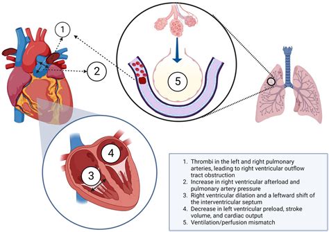 Frontiers Hemodynamic And Respiratory Support In Pulmonary Embolism