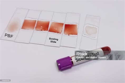 겸상 적혈구 빈혈 겸상 적혈구 질환 진단에 대한 겸상 적혈구 검사를 위해 혈액 도말 및 혈액 샘플을 준비하는 기술자 0명에 대한 스톡 사진 및 기타 이미지 Istock