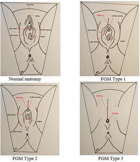 Operative Obstetric Care Of Women Who Are Victims Of Fgm Article Glowm