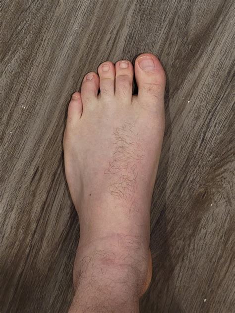 Pots And Blood Pooling Part Of Venous Insufficiency Or Something Else