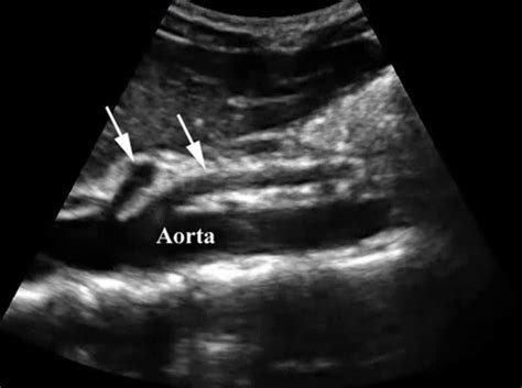 Aorta Flashcards Quizlet