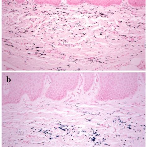 Diffuse Grey Blue Macular Pigmentation On Of The Hard Palatal Mucosa Download Scientific