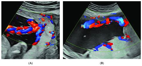 Color Doppler Of The Placenta Showing A Marginal A And Velamentous