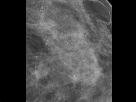 Atlas Of Breast Cancer Early Detection