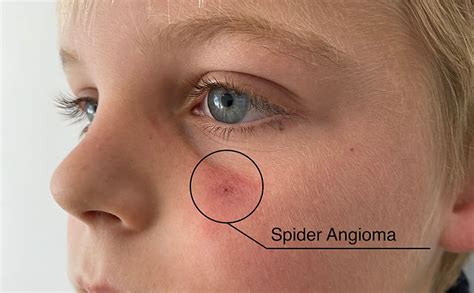 Spider Angioma Causes