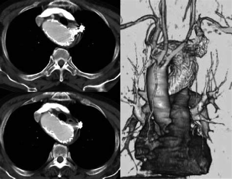 Post Procedure Operative Computed Tomographic Ct Findings A B Ct