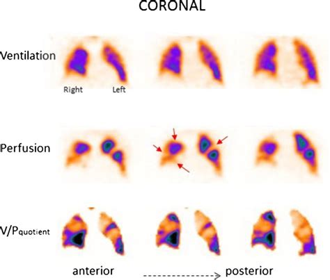 Eanm Guideline For Ventilationperfusion Single Photon Emission