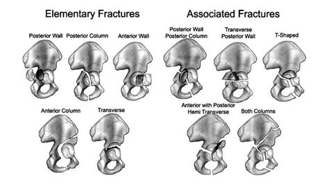 Acetabular Fractures Pptx