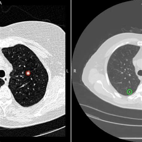 B A Nodule Vs Non Nodule Comparison The Left Image Is A Nodule Download Scientific Diagram